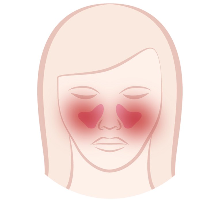 ¿Sabes si tu dolor de cabeza es por sinusitis? Te lo explicamos